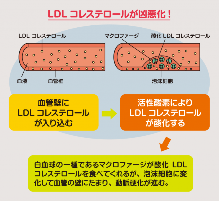動脈硬化と酸化LDL sdLDL | 高橋医院